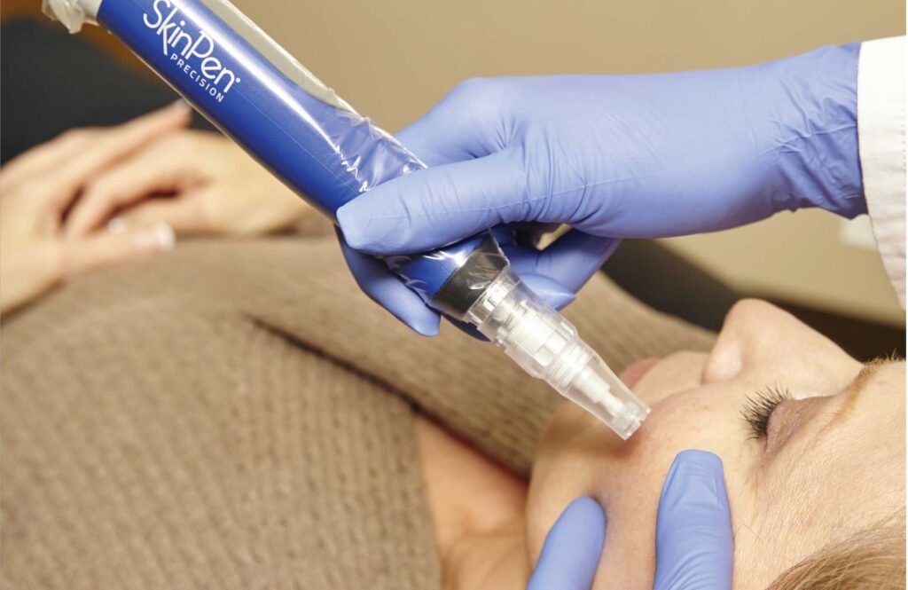 SkinPen Microneedling — Lohuis Filipović Medical Group