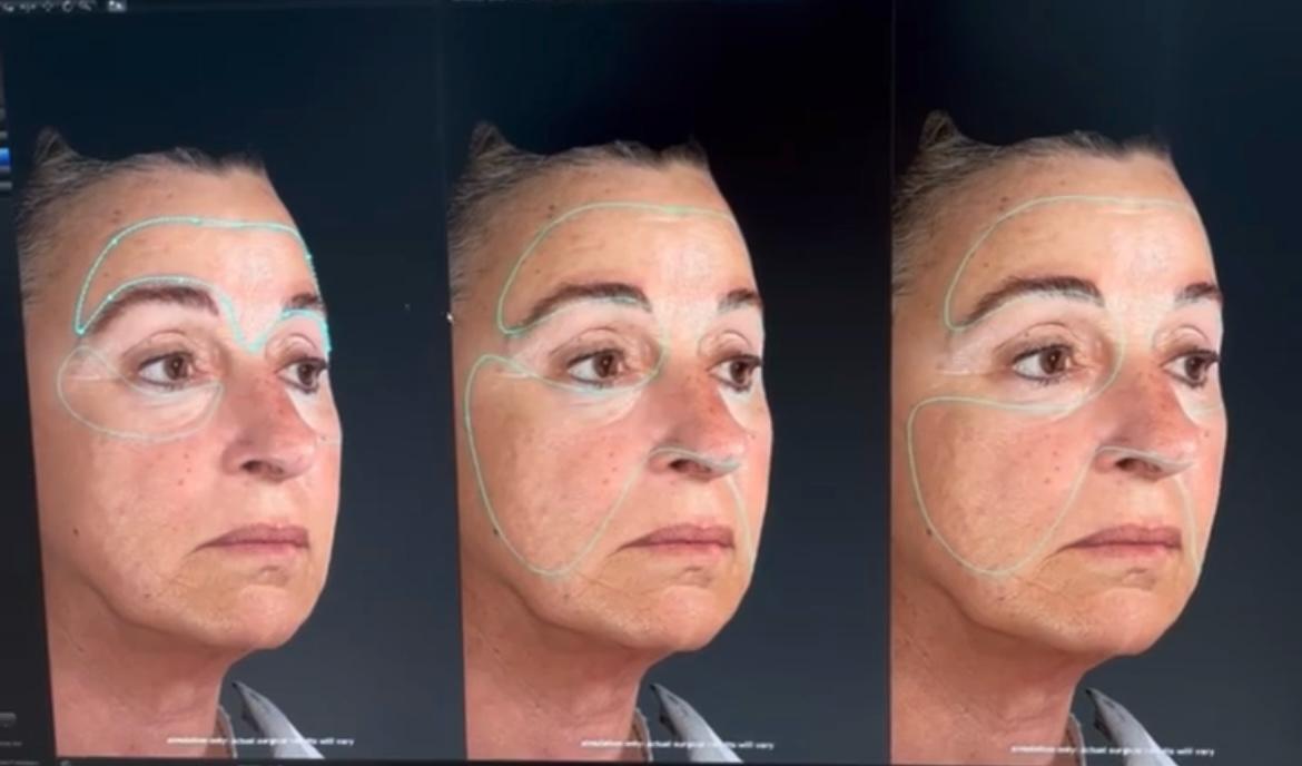 Facial skin analysis with the Vectra 3D device — Lohuis Filipović ...
