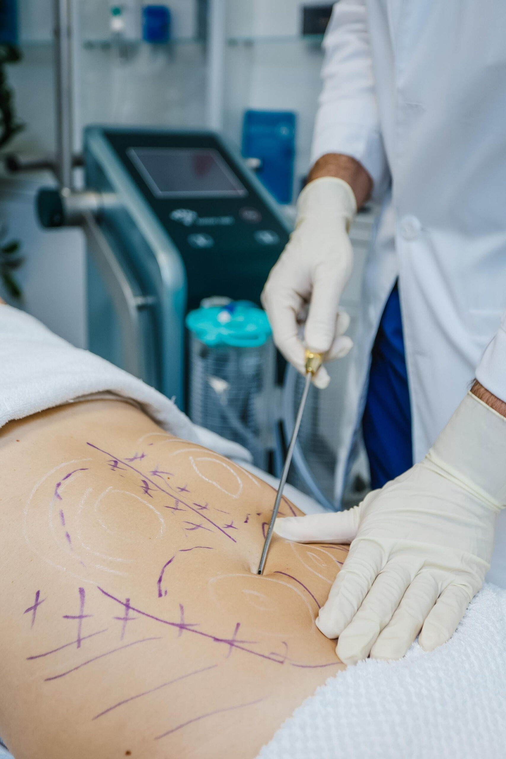 Liposuction Recovery: Classic vs. Water Jet Liposuction — Lohuis ...